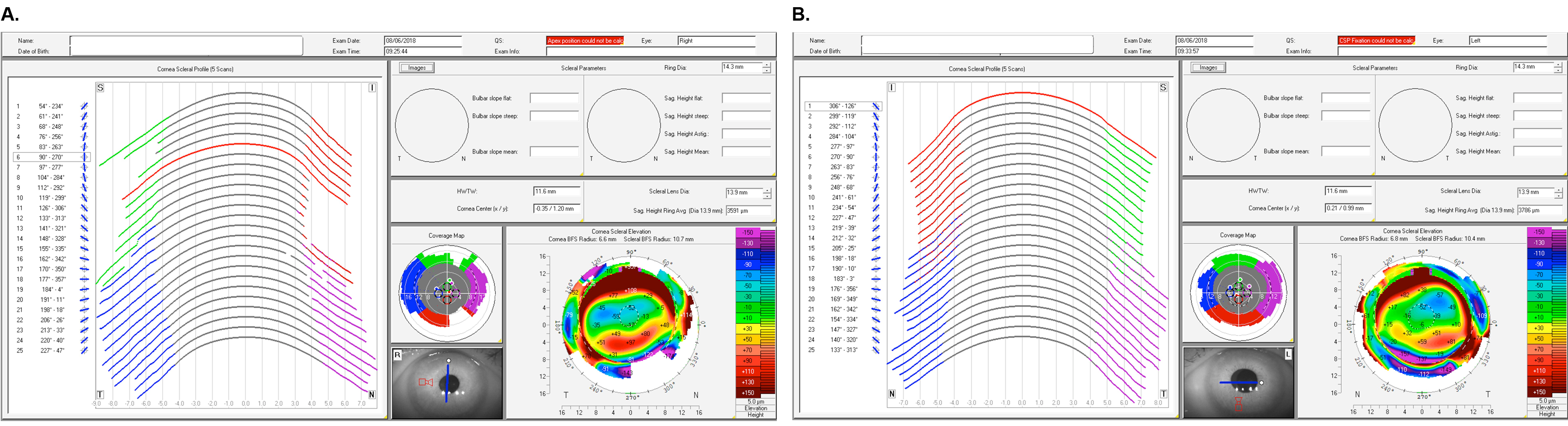 Pentacam CSP Software to Improve Efficiency and Effica...