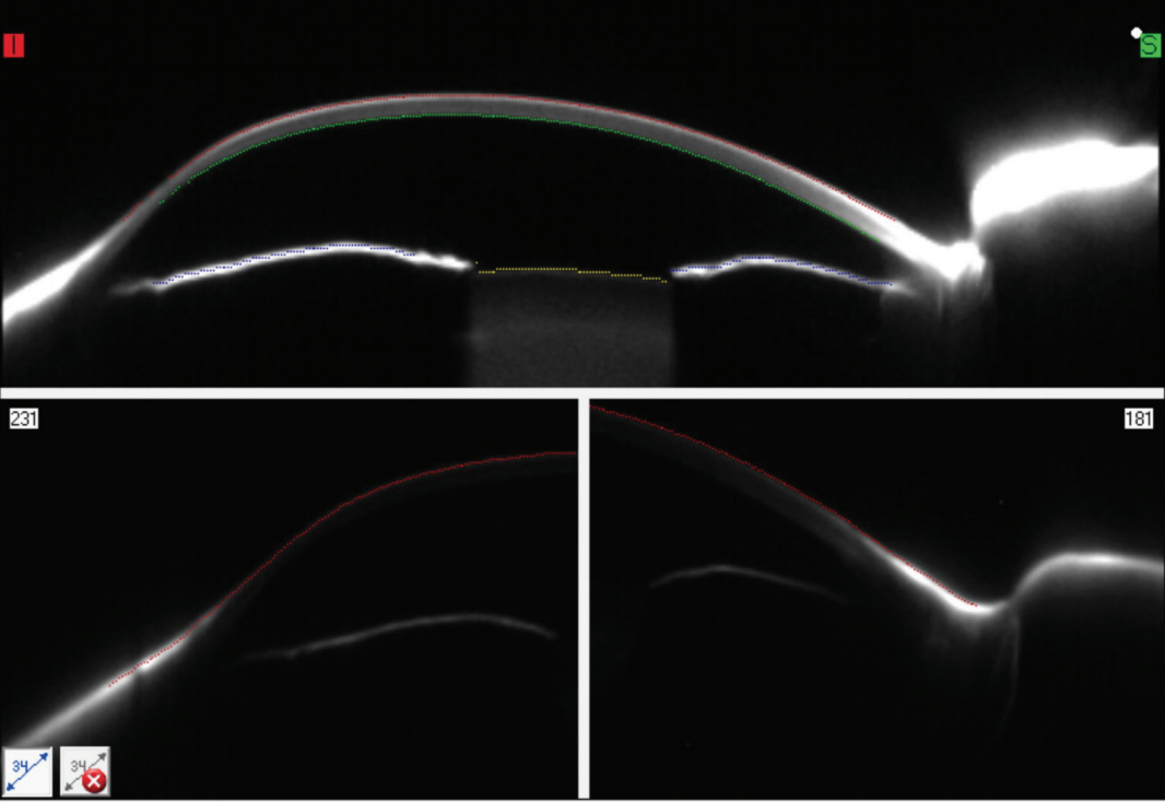 Pentacam CSP Software to Improve Efficiency and Effica...