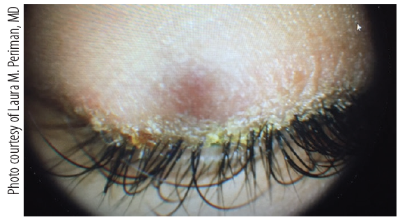 Cosmetic Use and Dry Eye