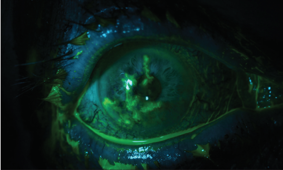 A Primer on Herpes Simplex Keratitis