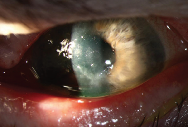 A Primer on Herpes Simplex Keratitis