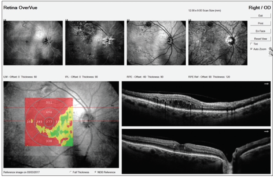 Standard Tools and Tests for Diagnosing Diabetic Retin...