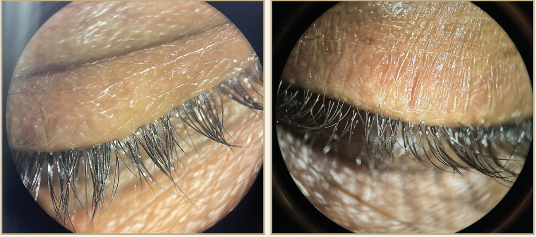The Demodex Blepharitis PatientJourney With XDEMVY®