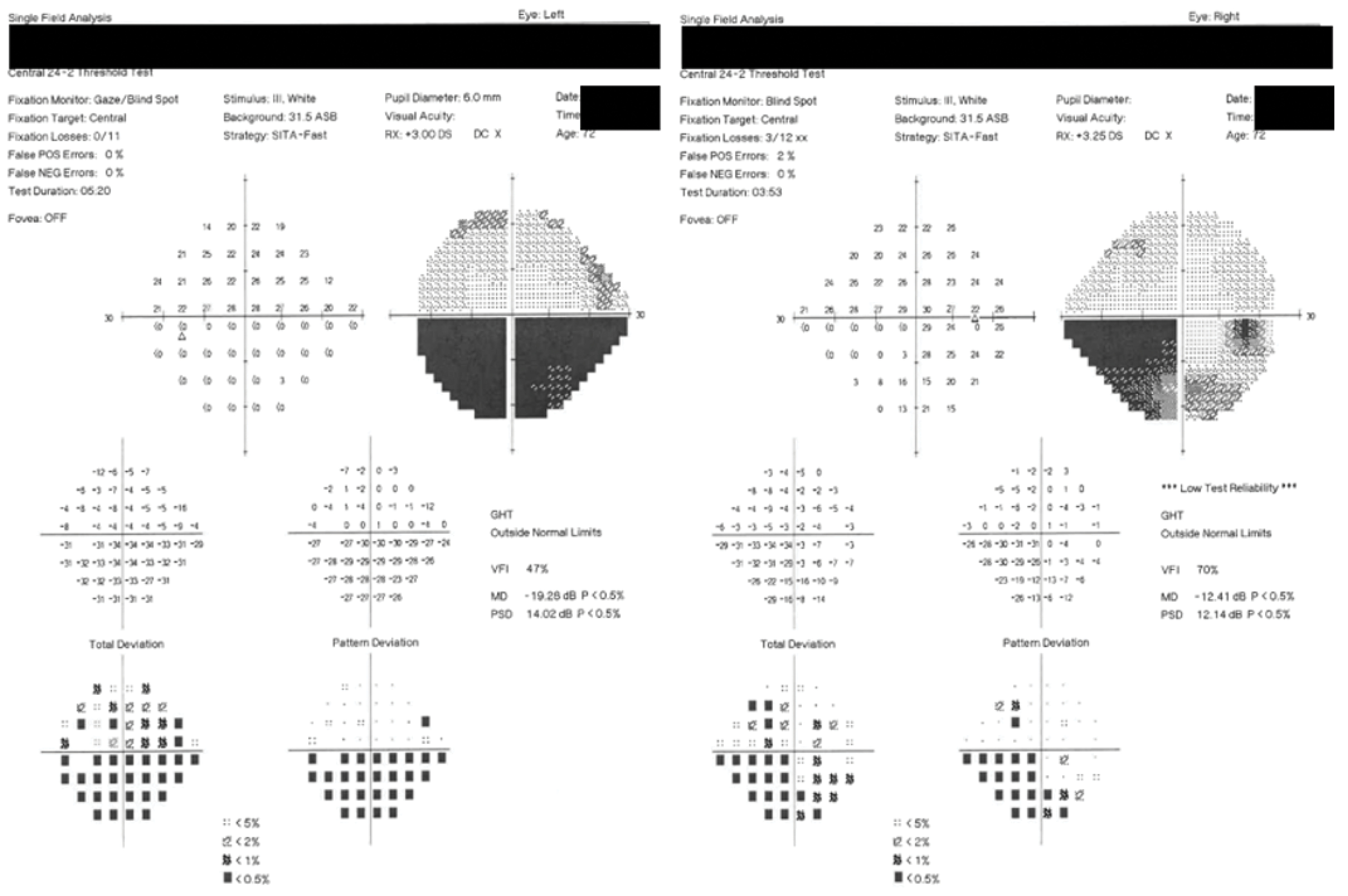 A Case of Multiple Visual Field Defects Secondary to G...