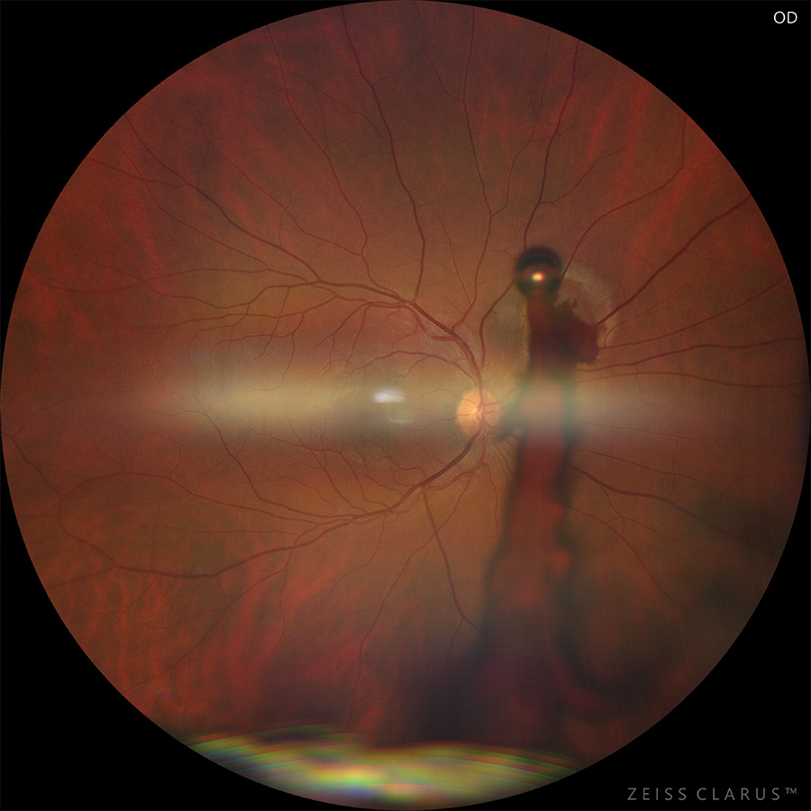 A Sneaky Sliver of Metal - Modern Optometry