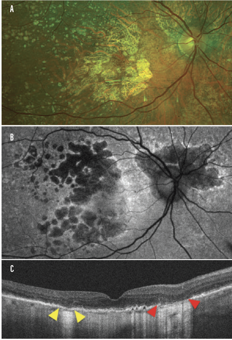 A Collaborative Approach to Geographic Atrophy Management - Modern ...
