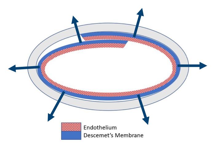 EverSight Launches Preloaded DMEK EndoGlide - - Modern Optometry